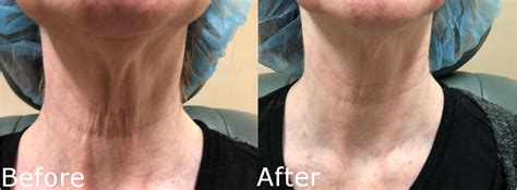 Titan Skin Tightening Procedure Hartford Ct