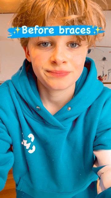 N O R R I S N U T S On Instagram Braces In 2025 Braces Boys