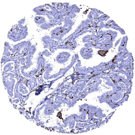 Cancer Tissue Gallery Gtx04429 Genetex