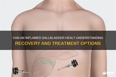 Can An Inflamed Gallbladder Heal Understanding Recovery And Treatment Options Medshun