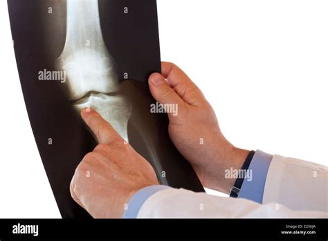 Medical Doctor Pointing With Finger At Radiograph Of Knee Joint Bone