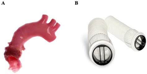 Prosthetic Heart Valves More Than Half A Century Of Innovation—an Overview