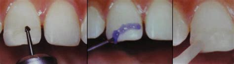 Traumatismo Dental En NiÑos Slide Set