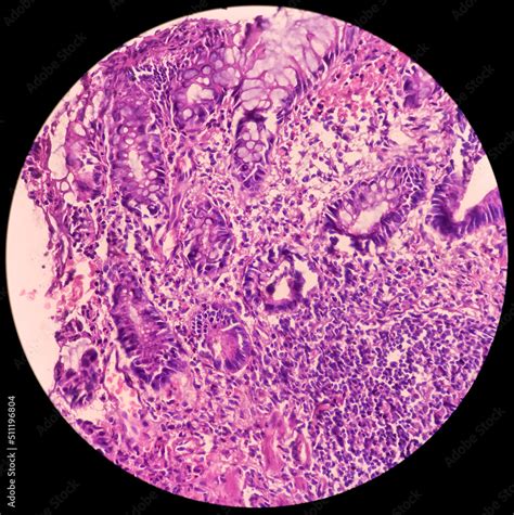 Terminal Ileum Biopsy Chronic Nonspecific Ileitis Or Inflammation Of Ileum Show Ileal Mucosa
