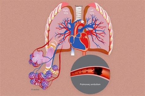 Hypertension Types Stages Causes Symptoms And Treatments