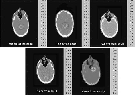 Isocenter Positions For The Five Cases Presented On The CT Data Set Download Scientific Diagram
