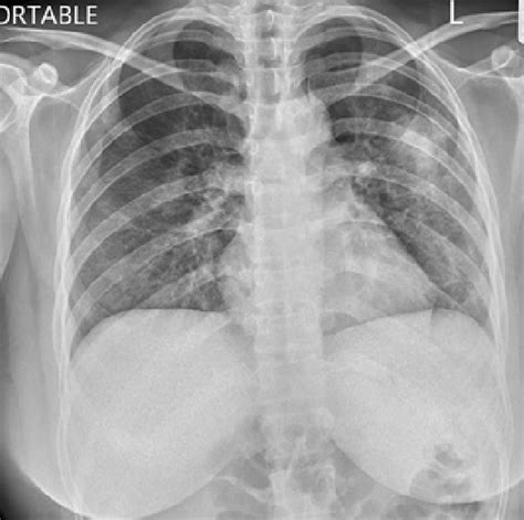 Frontal Ap Cxr Shows An Increase Of Patchy Opacities With Ground Glass Download Scientific
