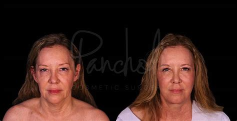 Facial Fat Transfer Case 1884 Pancholi Cosmetic Surgery