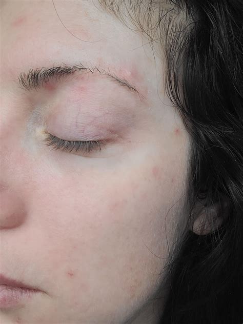 What Is This Pimple Like Spots Around Eyebrows And Neck R