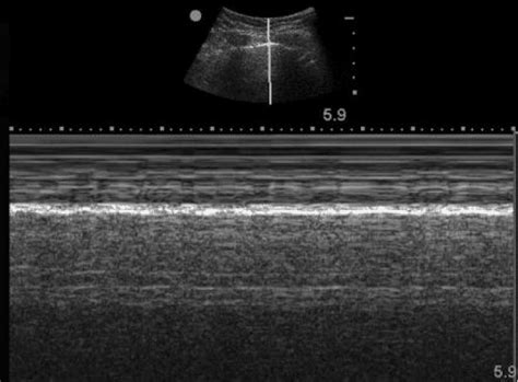 Pneumothorax Can Pocus Lung Help Point Of Care Ultrasound Certification Academy