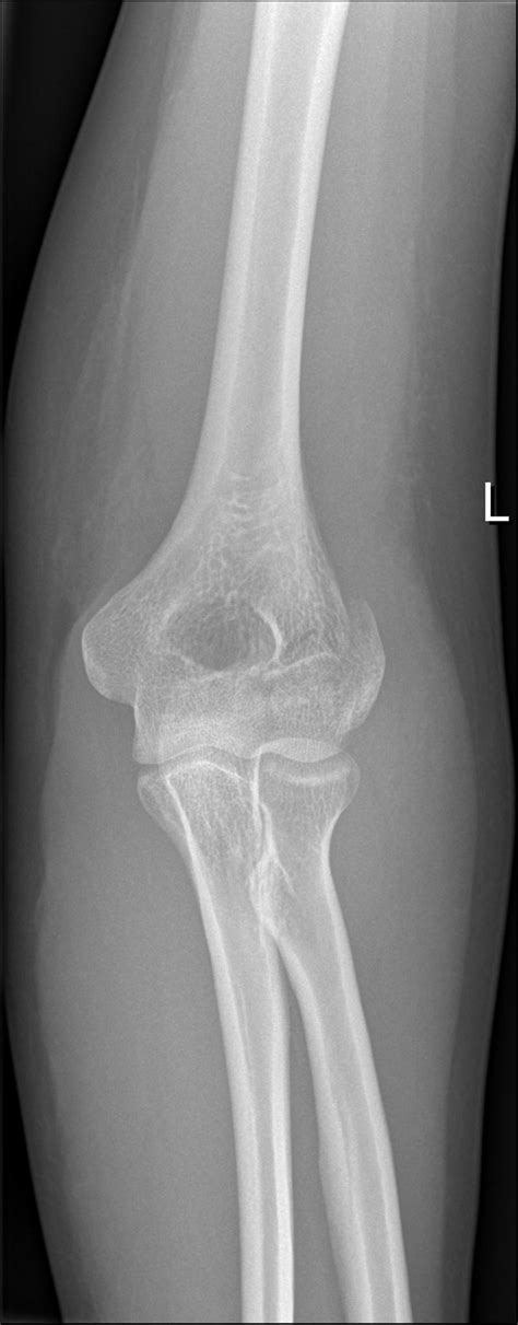 Bone Fracture Detection Object Detection Dataset And Pre Trained Model By Test