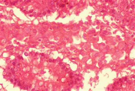Mucosa Of The Small Intestine Epithelioid Macrophages Having Foamy