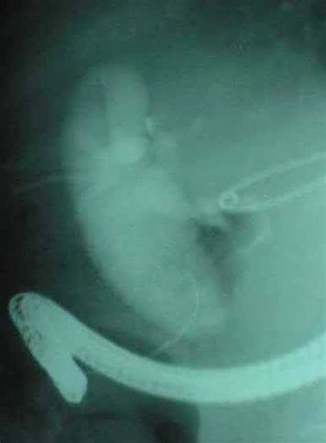 Endoscopic Retrograde Cholangiopancreatography Evaluation Of The Download Scientific Diagram