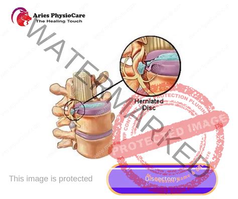 Discectomy Aries Physiocare