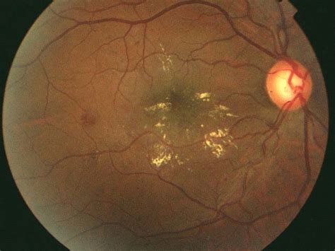 A Test Image 1 B Result Of Our Approach On A Where Exudates Are Download Scientific