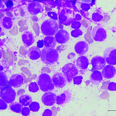Bone Marrow Aspiration Bone Marrow Aspiration Specimen From The