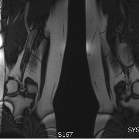 Mri Coronal View Demonstrating Saccular Aneurysmal Dilation Measuring