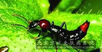 隐翅虫皮炎是什么 翅虫皮炎 北京京城皮肤医院 北京医保定点机构