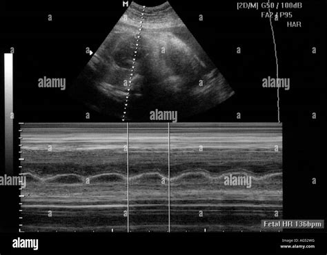 Fetal Cardiac Ultrasound