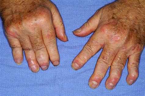 Psoriatic Nail Dystrophy Nail Ftempo