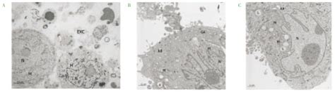 ETM Study Of Electroporation Influence On Cell Morphology In Human Malignant Melanoma And Human