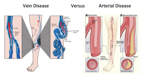Vein Disease Versus Arterial Disease