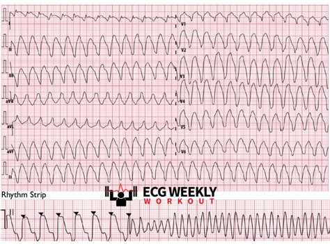 STAT ECG Diagnoses Ventricular Fibrillation After Synchronized