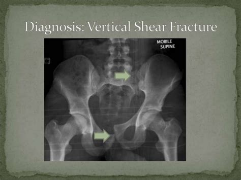 Vertical Shear Pelvic Fracture