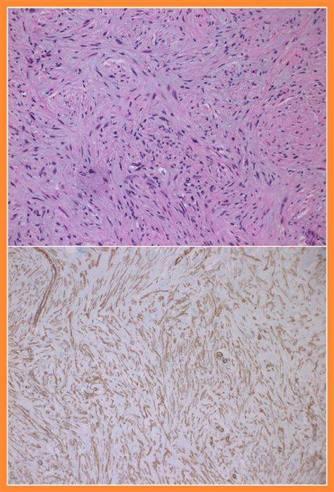 Top Panel Demonstrates Spindle Shaped And Pleomorphic Epithelial Cells Download Scientific