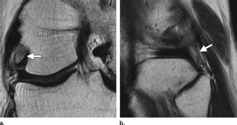Oblique Popliteal Ligament And Arcuate Popliteal Ligament
