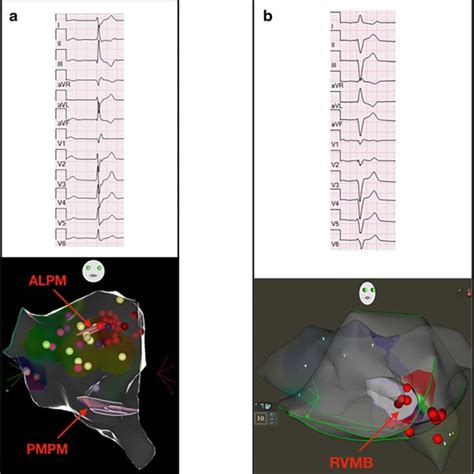 Single Patient Example Of Complex Ventricular Ectopy With Download Scientific Diagram