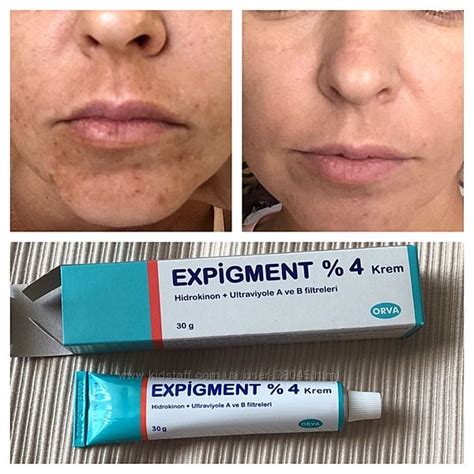 Відбілюючий крем Експігмент Expigment 4%, 30 г – tvoya-krasa.com.ua ...