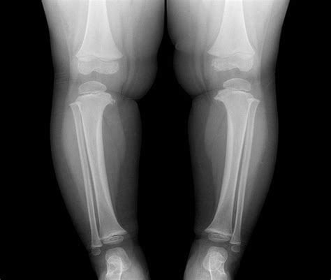 Tibial Varum Kevinroot Medical