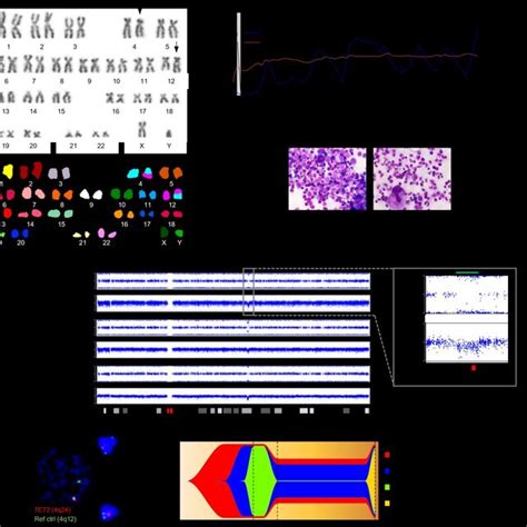 Biallelic Tet2 Mutation In A Patient With 5 Aza Sensitive Aml A