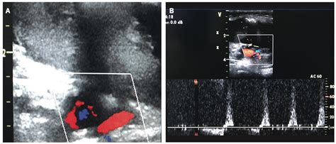 Ultrasound Guided Thrombin Injection For Treating Iatrogenic Femoral