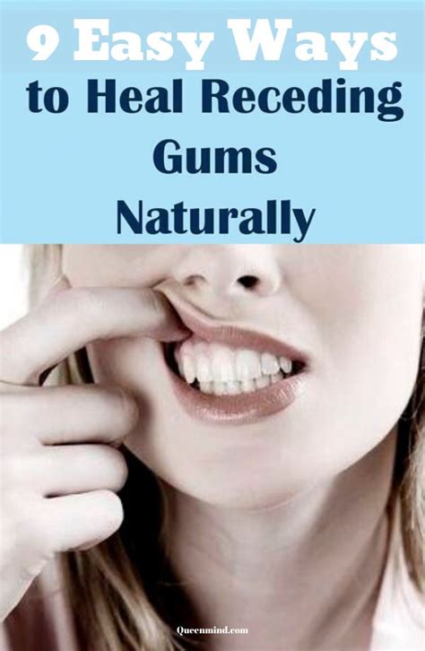 9 Easy Ways To Heal Receding Gums Naturally Receding Gums Gum