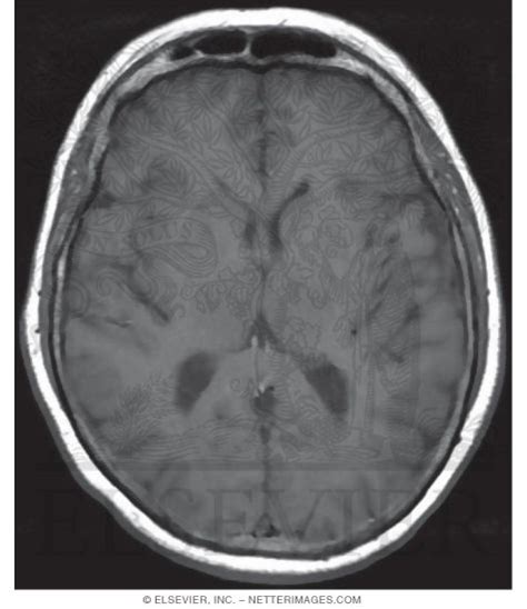 T1 Mri Of A Patient With Ventricles Of Normal Size