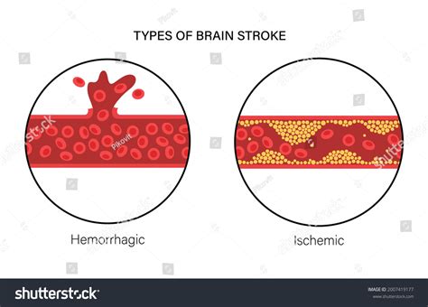 1398 혈관 파열 이미지 스톡 사진 및 벡터 Shutterstock