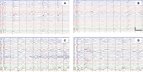 Drug‐induced Eeg Pattern Predicts Effectiveness Of Ketamine In Treating