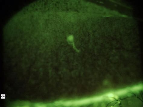 Palpebral Conjunctiva Foreign Body Sonoran Desert Eye Center