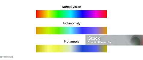 Protanomaly And Protanopia Stock Illustration Download Image Now Color Blindness Medical