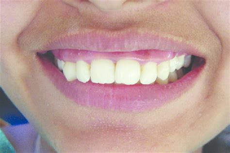 Profile View Of Gummy Smile Due To Delayed Passive Eruption Download