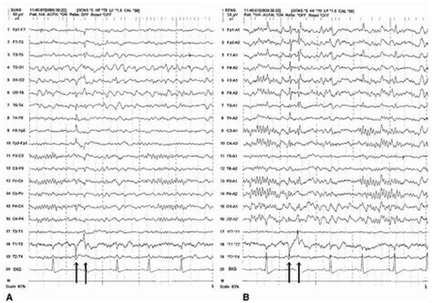 Benign Eeg Patterns Neupsy Key
