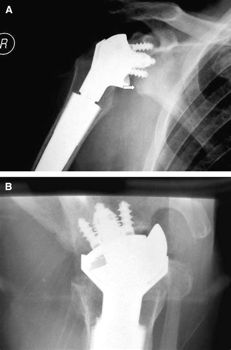 Dissociated Polyethylene Liner After A Reverse Shoulder Replacement A