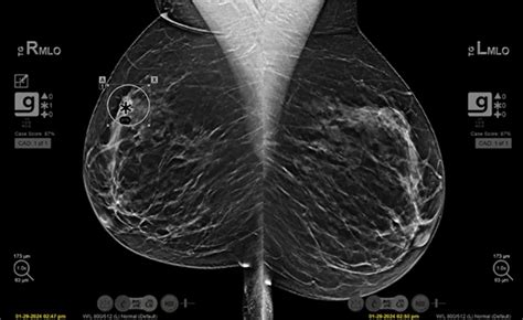 How Ai Is Revolutionizing Breast Cancer Detection And Saving More Lives
