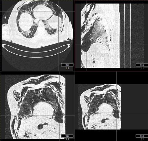 Patient 1 Ct Scans Showing Left Sided Pneumothorax Along With Massive