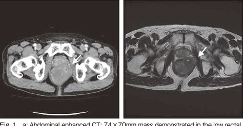 Figure 1 From Giant Rectal Gastrointestinal Stromal Tumor Successfully Resected After Neoajuvant