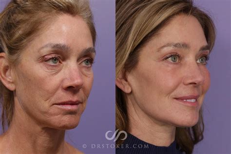 Facelift Traceless Facelift Before And After Pictures Case 1849 Los