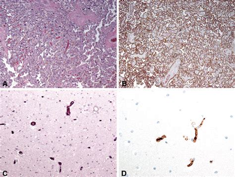 Amnion Nodosum Semantic Scholar