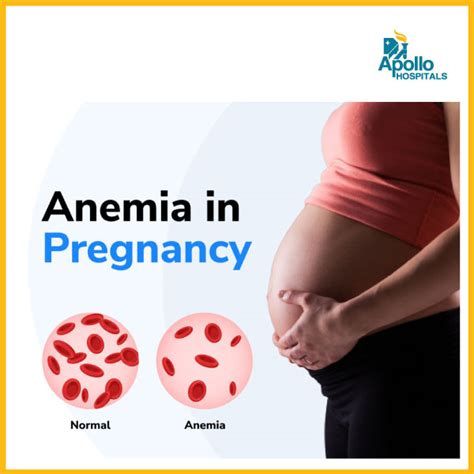 How Can I Treat Anemia In Pregnancy Naturally Apollo Hospitals